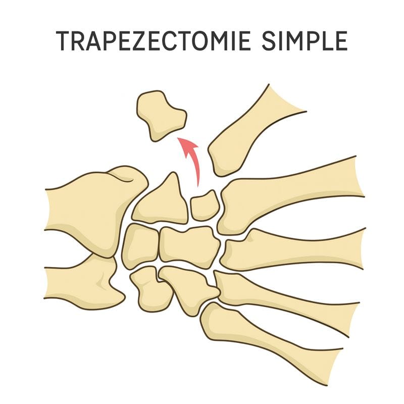 Comment soigner la rhizarthrose ? - Le Traumato