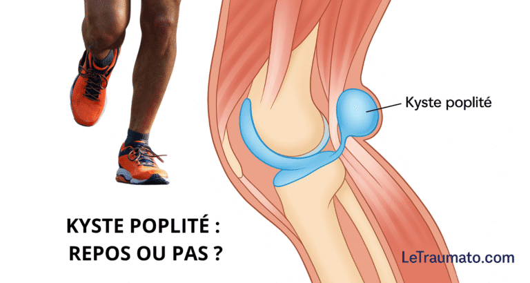Kyste poplité : repos ou pas ? - Le Traumato