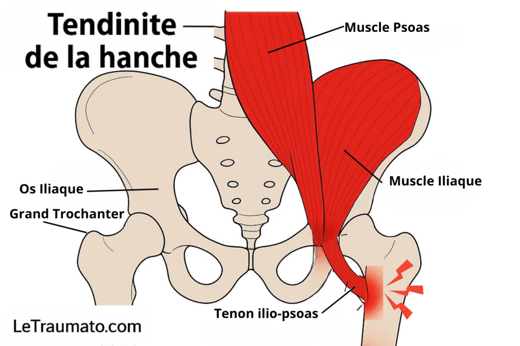 Tendinite de la hanche - Le Traumato