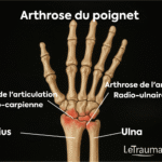 Prothèse du pouce et rhizarthrose - Le Traumato
