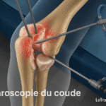 Bursite du coude - Le Traumato