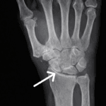 Les types d’Arthrose du poignet - Le Traumato