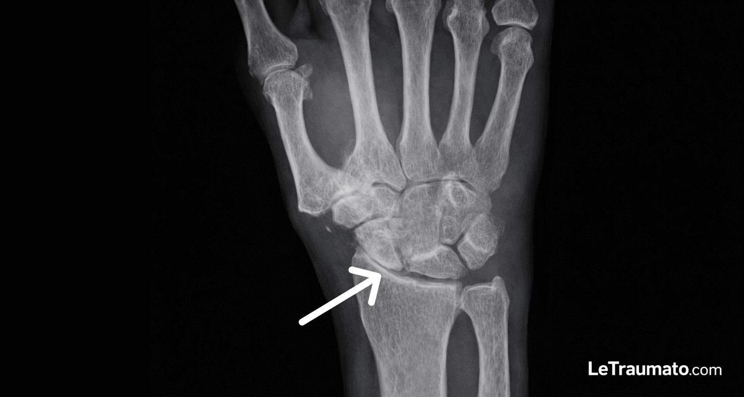 Arthrose radiocarpienne - Le Traumato