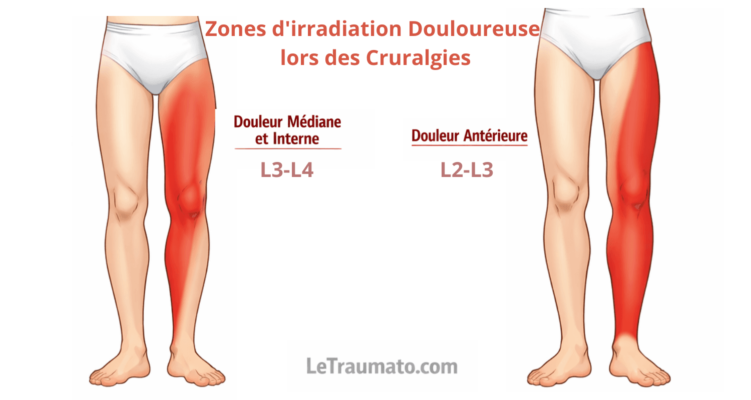 Nerf crural : anatomie, trajet et zones de douleur expliquées ...